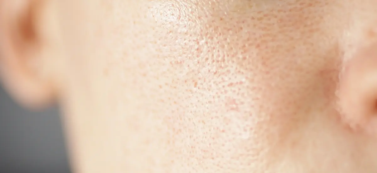 Here's How You Can Manage The Look Of Enlarged Pores: Ayurveda-Inspired ...